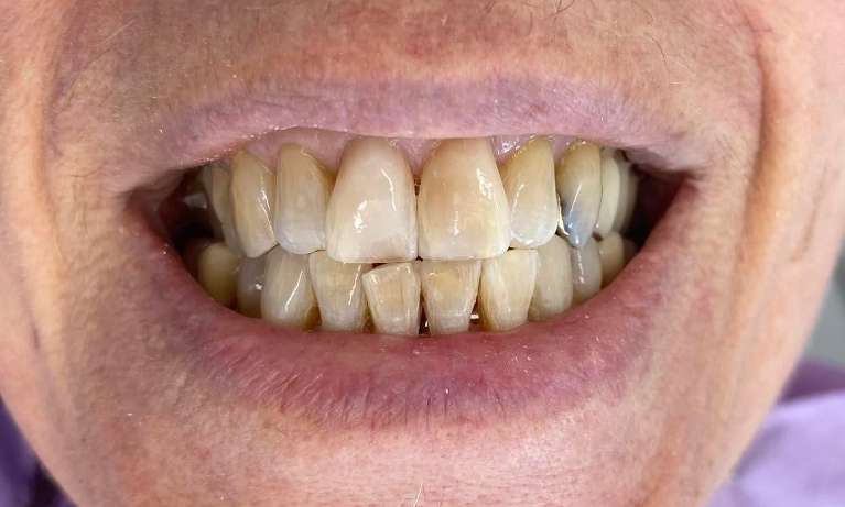 Before & After Photos | Veneers Gallery | Paddington NSW